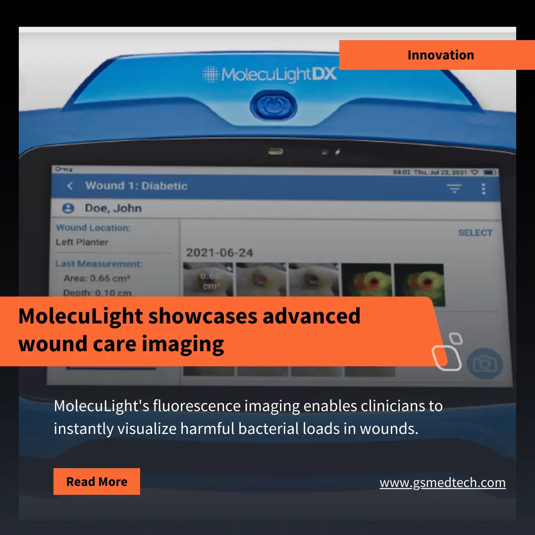 MolecuLight showcases advanced wound care imaging