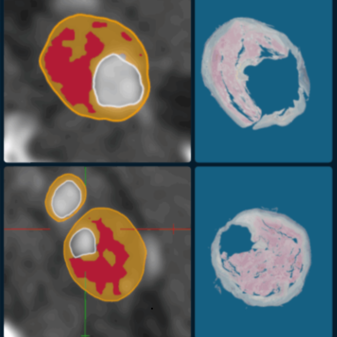 Elucid launches AI software for arterial plaque measurement