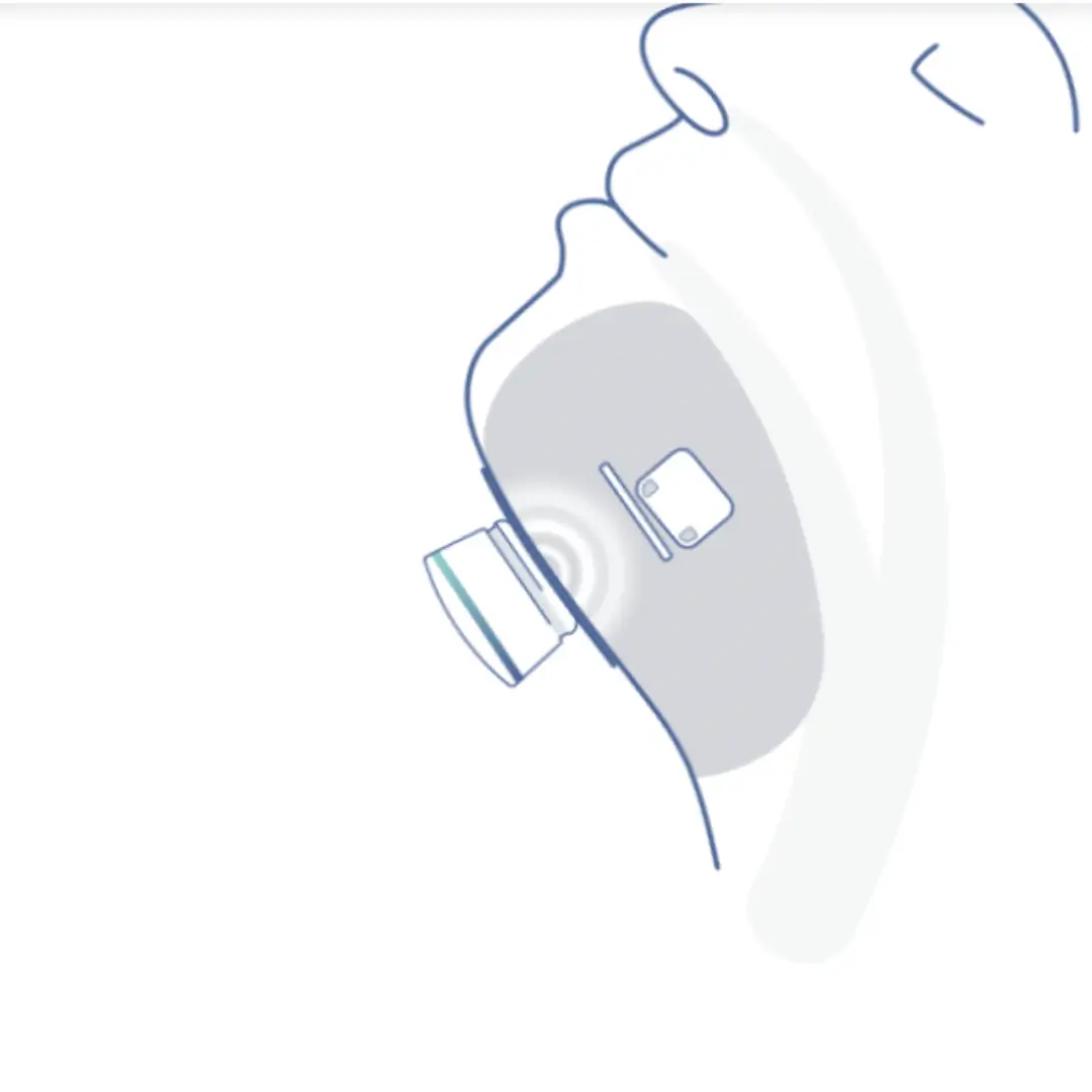 Nyxoah raises $77M to support Genio sleep apnea neuromod rollout