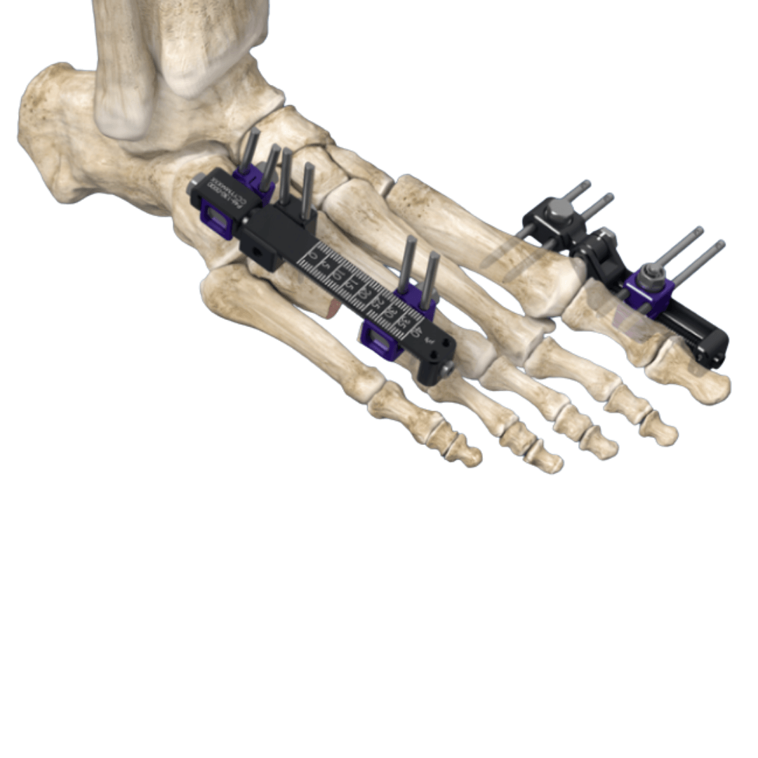 Zimmer Biomet launches new foot and ankle system